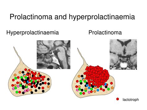 Ppt Pituitary Disease Powerpoint Presentation Free Download Id1095541