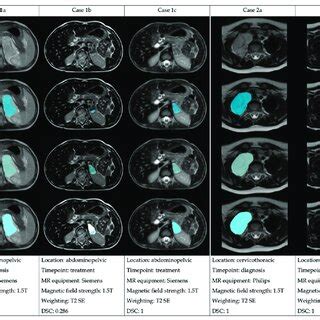 PDF Independent Validation Of A Deep Learning NnU Net Tool For Neuroblastoma Detection And