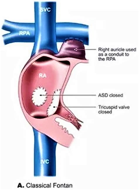 Fontan Procedure Uses Types Recovery And Complications