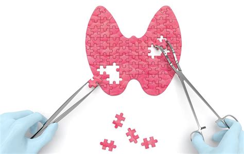 This Is What Its Like To Have Your Thyroid Removed Prevention