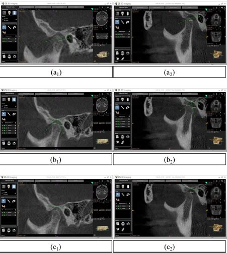A C A 1 Pre Treatment T1 Condylar Position A 2 Post Treatment Download Scientific