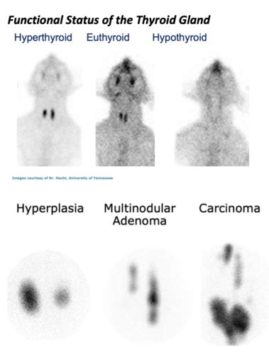 Lecture 16 Hyperthyroidism Flashcards Quizlet