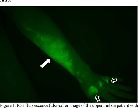 Figure 1 From Toward Development Of A Portable System For 3d Fluorescence Lymphography
