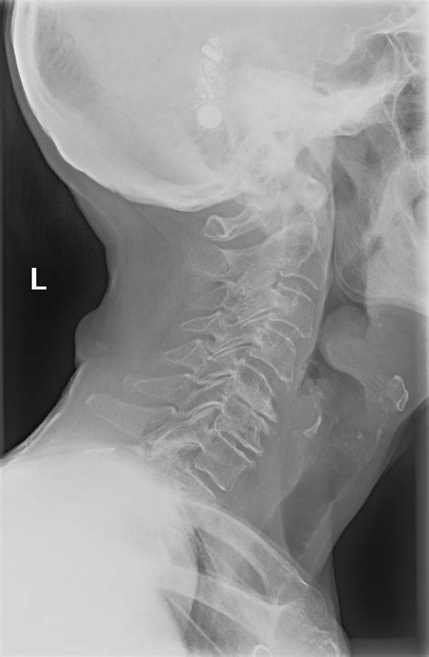 Epiglottitis Thumb Sign