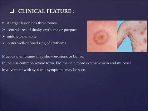 Erythema Multiforme Pptx