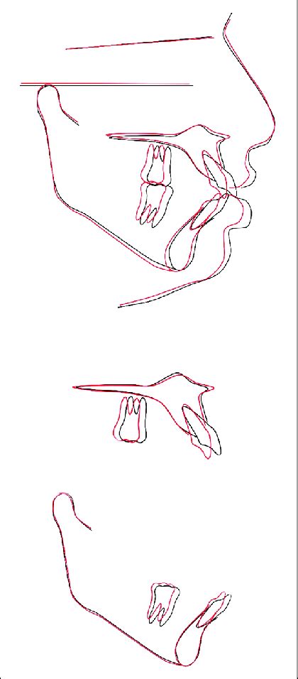 Post Treatment Lateral Cephalogram Download Scientific Diagram