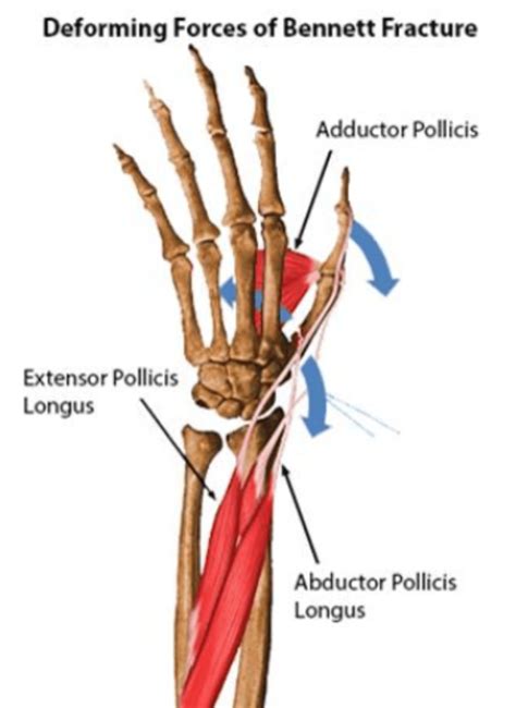 Base Of Thumb Fractures A Review Of Anatomy Classification And Management Pmc