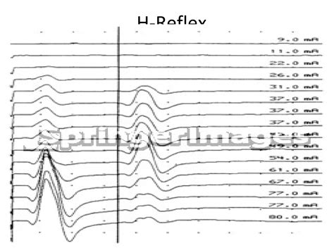Late Responses F Wave And Hreflex Ppt