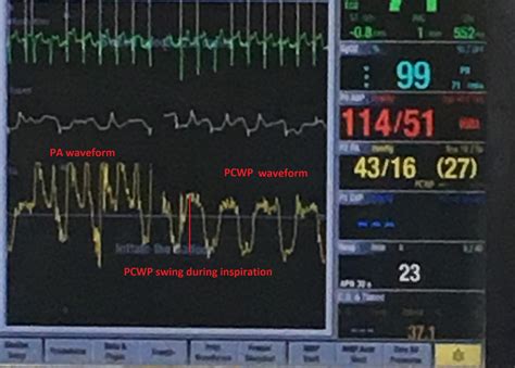 Utilizing Cvp Waveforms To Assess The Intensity Of Inspiratory Efforts