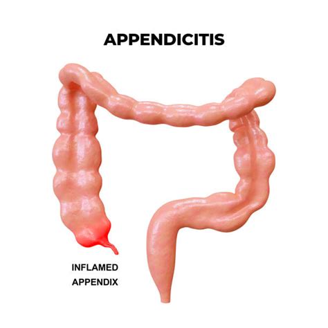 Infected Appendix