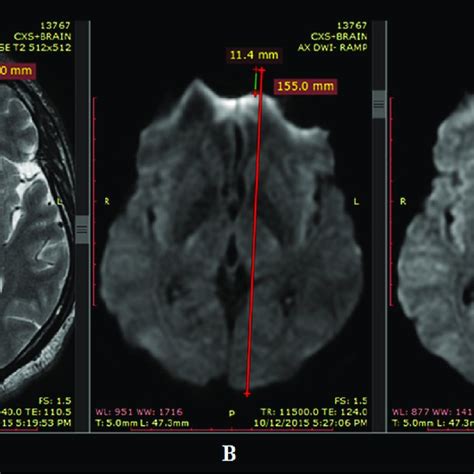 Measurement And Comparison Of Geometric Distortion Artifact In The Same Download Scientific