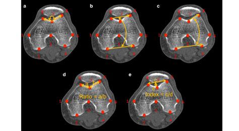 Schematic Illustration Of The Trochlear Ratios A Sulcus Angle B
