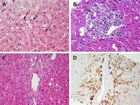 Liver Histology Clinics In Liver Disease