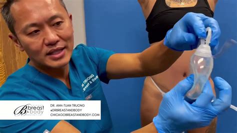 Abdominal Jackson Pratt Drain