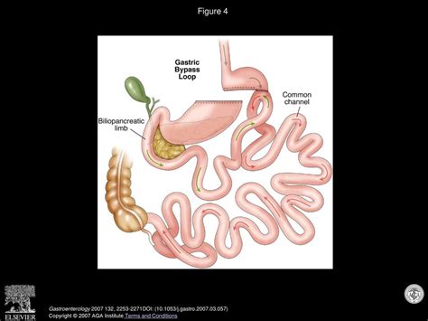 Bariatric Surgery A Review Of Procedures And Outcomes Ppt Download