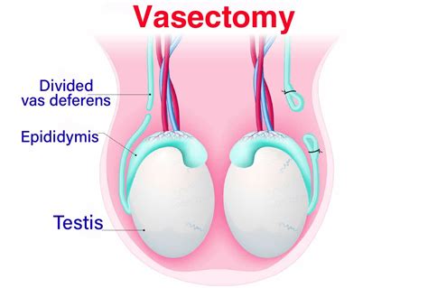 Vasectomy In Turkey Your Body Your Choice Cevre Hospital