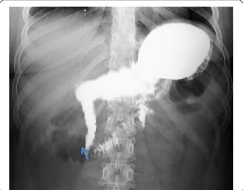 Barium Follow Through Shows Extrinsic Compression Of The Third Part Of Download Scientific