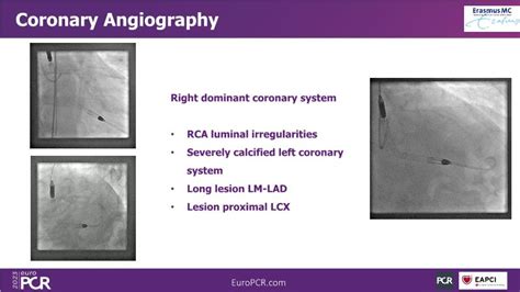 Orbital Atherectomy A Versatile Tool In Managing Complex Scenarios Of Vessel Calcification