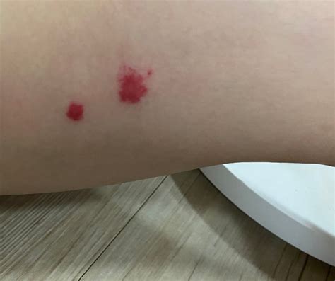 모기 물린자국 지식in