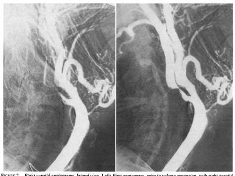 Figure 2 From Transient Ischemic Attacks Semantic Scholar