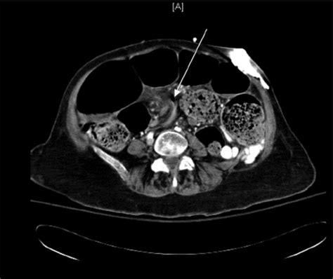 Sigmoid Volvulus Arrow Points To The Swirling Of The Download Scientific Diagram
