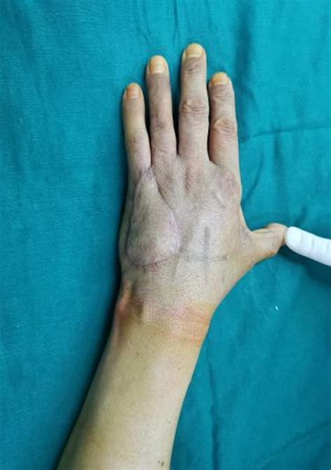 Clinical Effects Of The Modified Masquelet Technique Ijgm