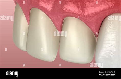 Maxillary Lateral Incisor Stock Videos Footage HD And 4K Video Clips Alamy