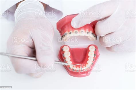 의사 치열 교정 의사는 치아에 중괄호 시스템이 배열되는 방법을 보여줍니다 건강 진단에 대한 스톡 사진 및 기타 이미지 건강 진단 건강관리와 의술 건강한 생활방식