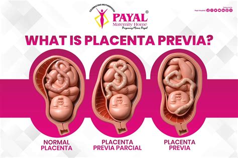 What Is Placenta Previa Payal Maternity Home Rajkot
