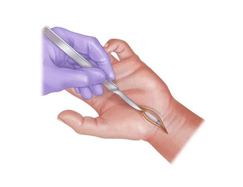 Frequently Asked Questions Carpal Tunnel Surgery NJ Maywood NJ