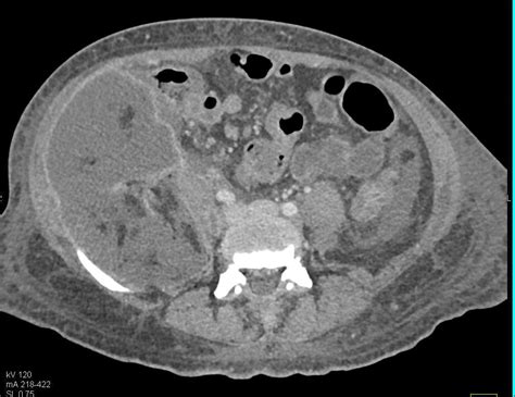 Perforated Appendix With Abscess Colon Radiology Case Studies