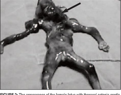 Figure 1 From Prenatal Diagnosis Of A Rare Congenital Anomaly Isolated