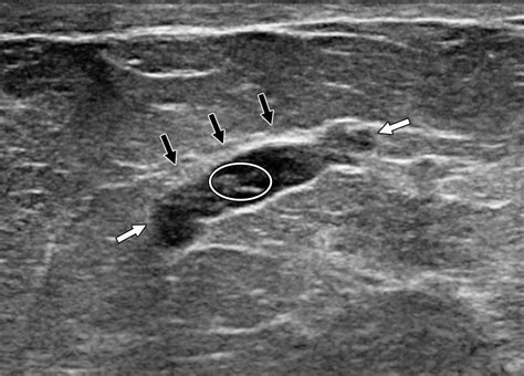 Duct Ectasia Definition At Luke Cornwall Blog