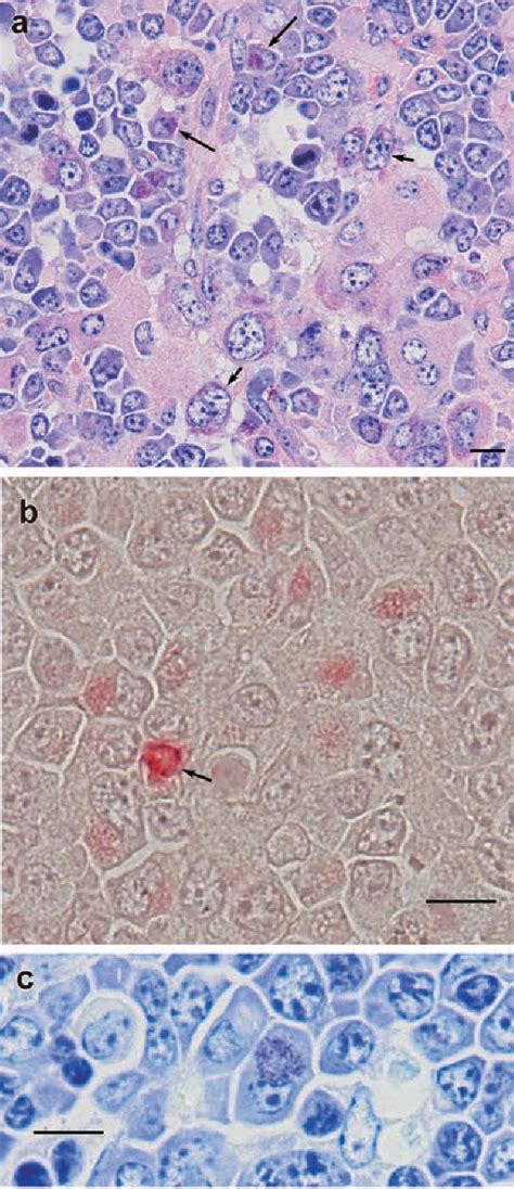 Figure 1 From Acute Myeloid Leukemia With Mastocytic And Megakaryocytic Differentiation In A