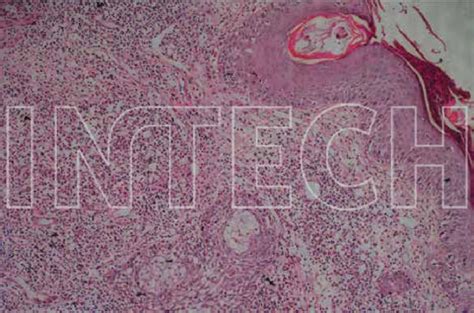 A Severe Rosacea Case That Has Intensive Inflammatory Infiltrate