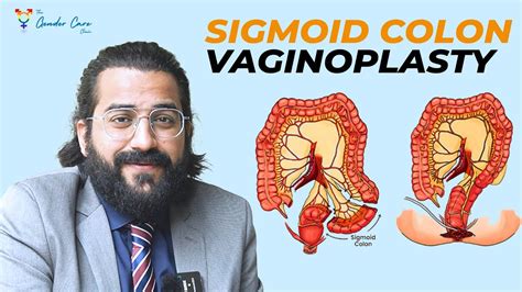Sigmoid Colon Vaginoplasty Dr Umang Kothari The Gender Care