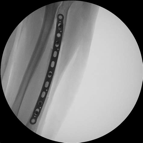 Forearm Fracture Solutions Acumed
