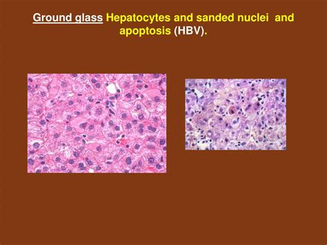 Hepatitis B Ground Glass Hepatocytes