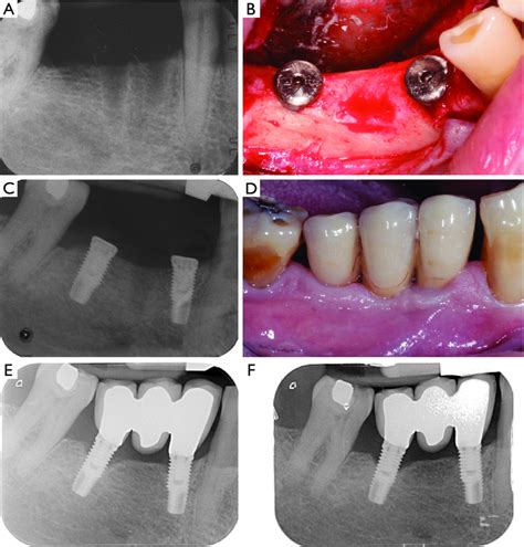 Initial Marginal Bone Loss On Different Implants Placed In The Same