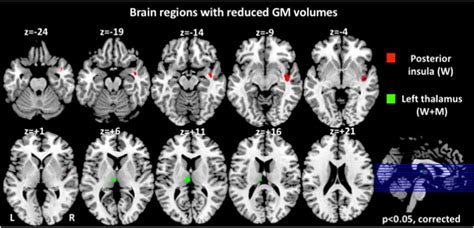 Voxel Based Morphometry Multiple Regressions Against Global Positive