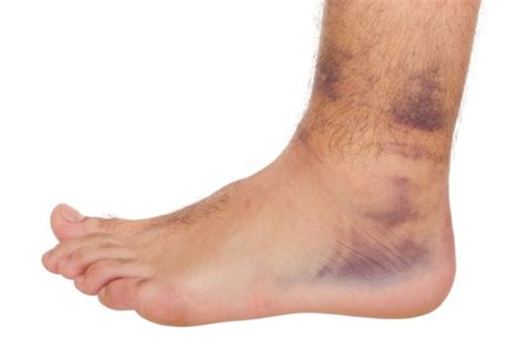 Why Do You Bruise So Easy On Legs