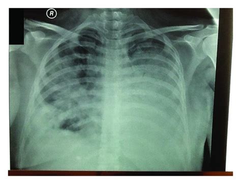Chest Radiograph Of Day Showing Diffuse Alveolar Opacities Extending Download Scientific