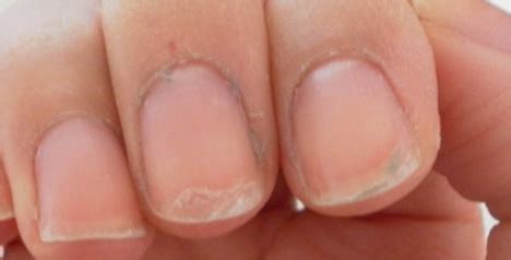 Do You Suffer With Splitting Brittle Nails Feetlife Foot And Nail Care