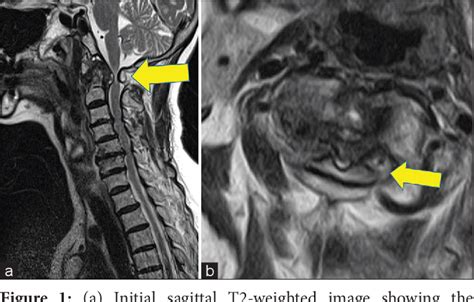 Figure 1 From Regression Of Retro Odontoid Pseudotumor Following Botulinum Injection Into