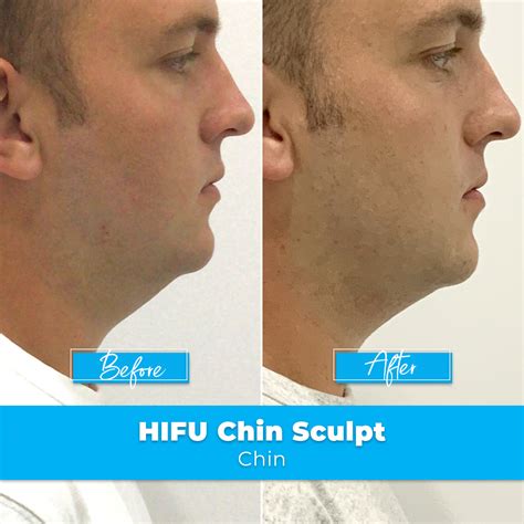 Chin Sculpting Hifu Double Chin Elite Body Contouring