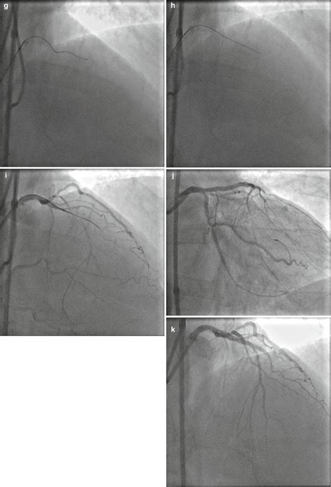 Specific Basic Techniques To Master In Cto Pci Thoracic Key