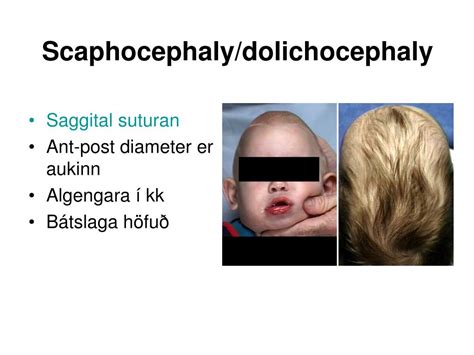 Ppt Craniosynostosis Powerpoint Presentation Free Download Id 3962283