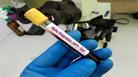 Alpha Fetoprotein Test During Pregnancy Results