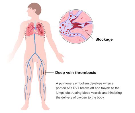 Pulmonary Embolism Pe