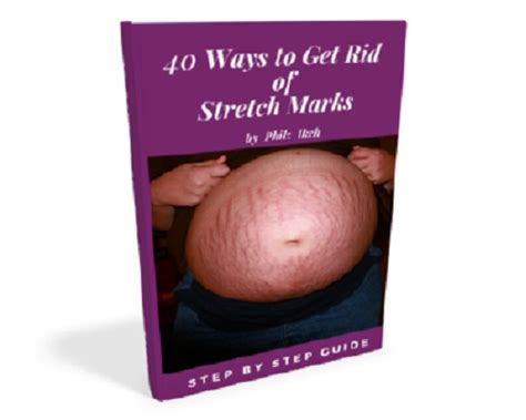 40 Ways To Get Rid Of Stretch Marks Gumroad